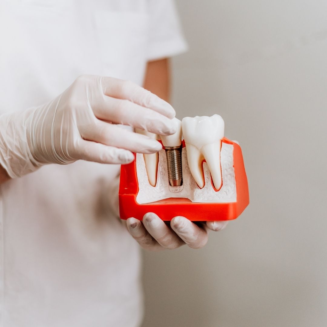 Implantes de Carga Inmediata - IPIRO | "A New Level Of Quality"