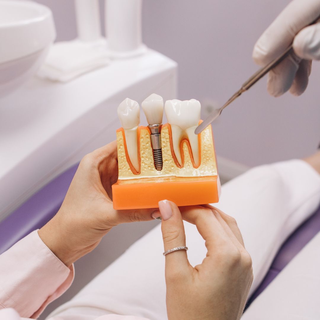 Injertos óseos para implantes dentales: ¿son realmente necesarios?